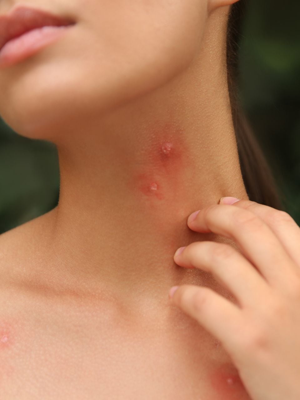How to differentiate between rash from a mosquito bite and other skin ...