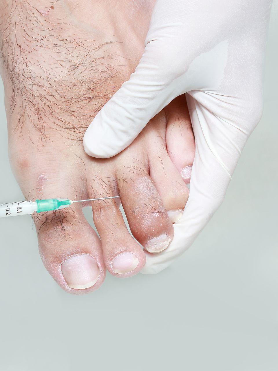 Tips to manage foot psoriasis