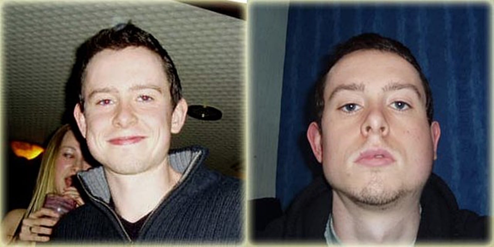 Mumps outbreak: In males, it can lead to swelling of testis, infertility