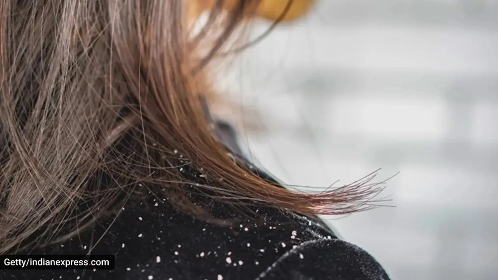 Can washing your hair regularly for 21 days keep dandruff away? | Life ...