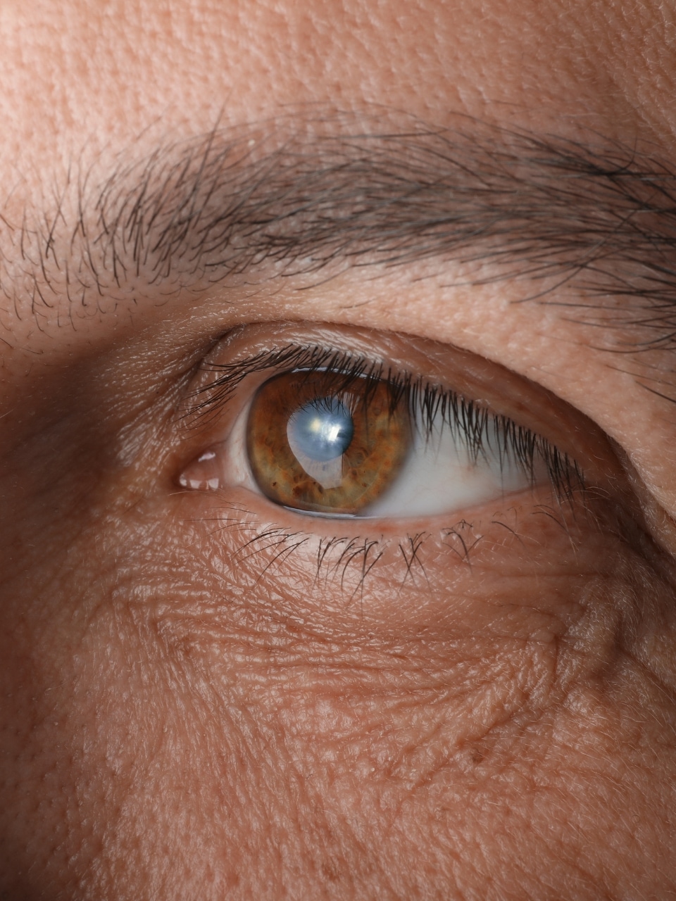 Insight into early-onset cataracts and youthful eye health