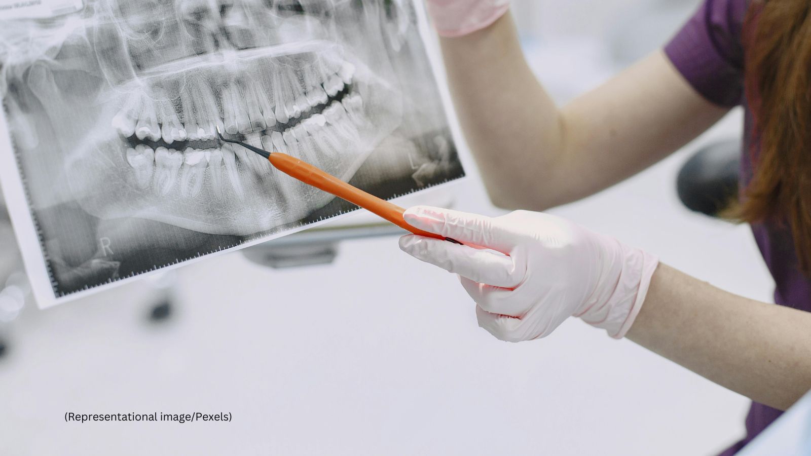 China man gets 23 teeth extracted, 12 implants placed in a day ...