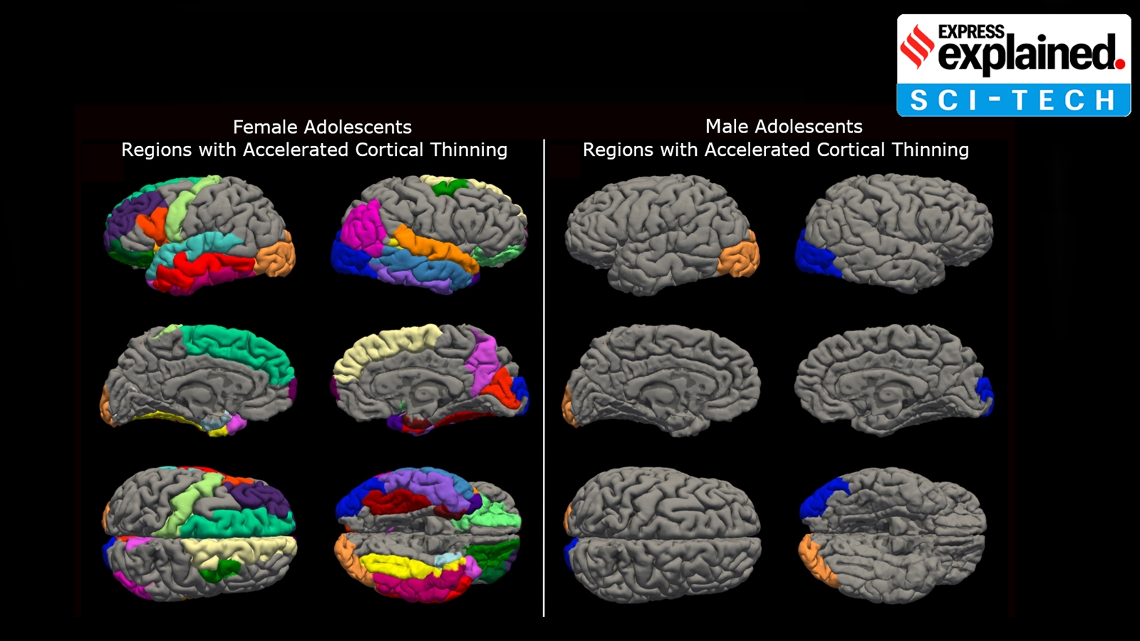 What a new study reveals on the ageing of teen girl brains during the ...