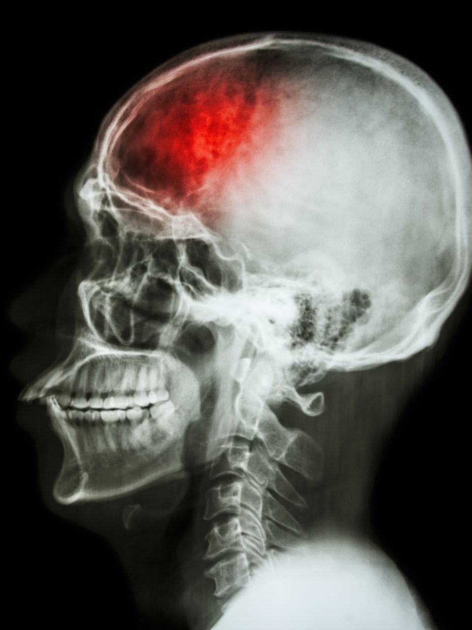 Understanding stroke: Key facts, prevention, and treatment options