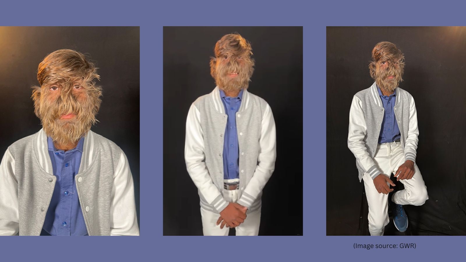 ‘I like how I am’: Madhya Pradesh teen with ‘werewolf syndrome’ secures ...