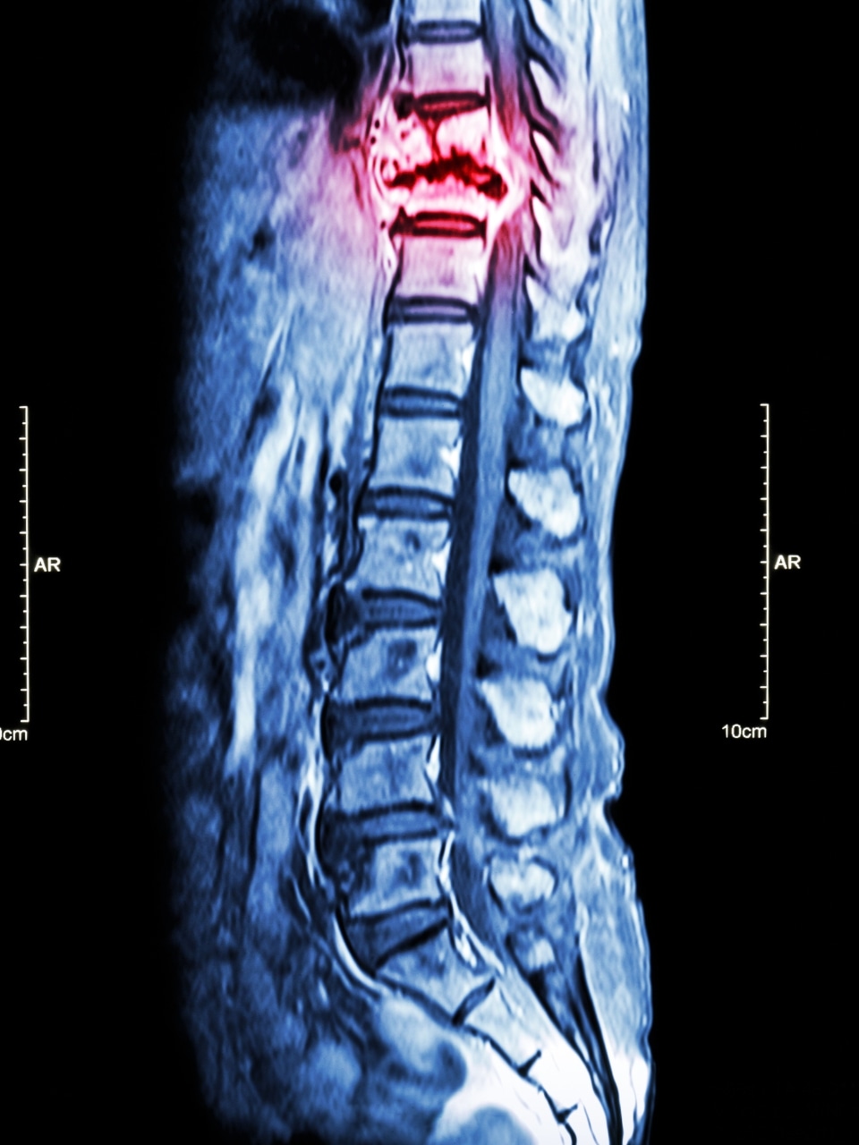 Prostate cancer and bone metastasis: Key facts and warning signs