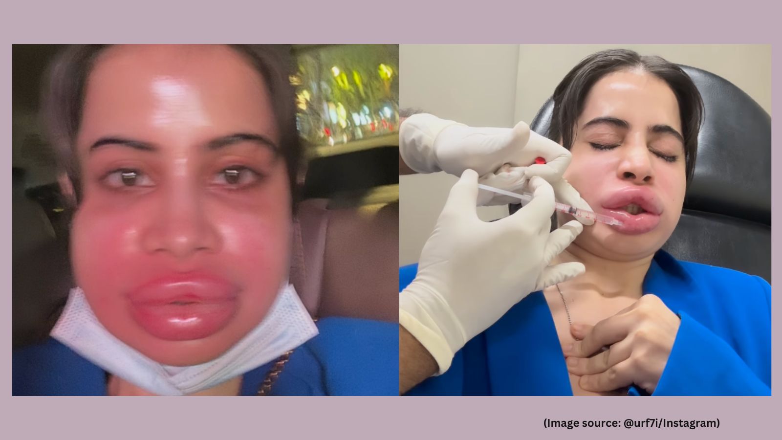 Uorfi Javed gets her lip fillers dissolved, shares unrecognisable video ...