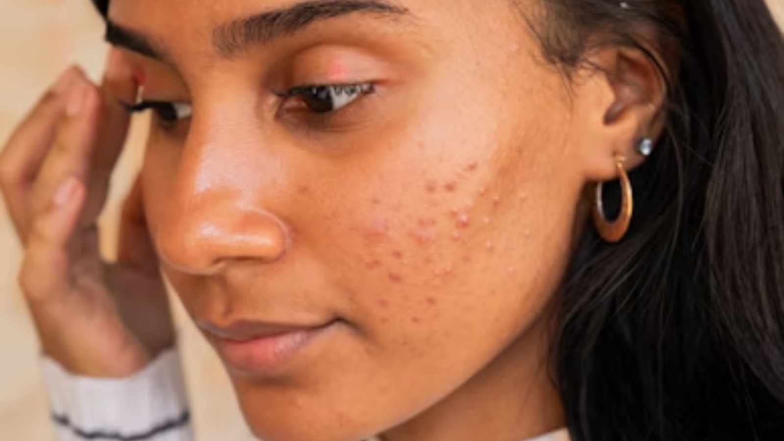 6 ways to naturally get rid of acne during monsoon | Lifestyle Gallery ...