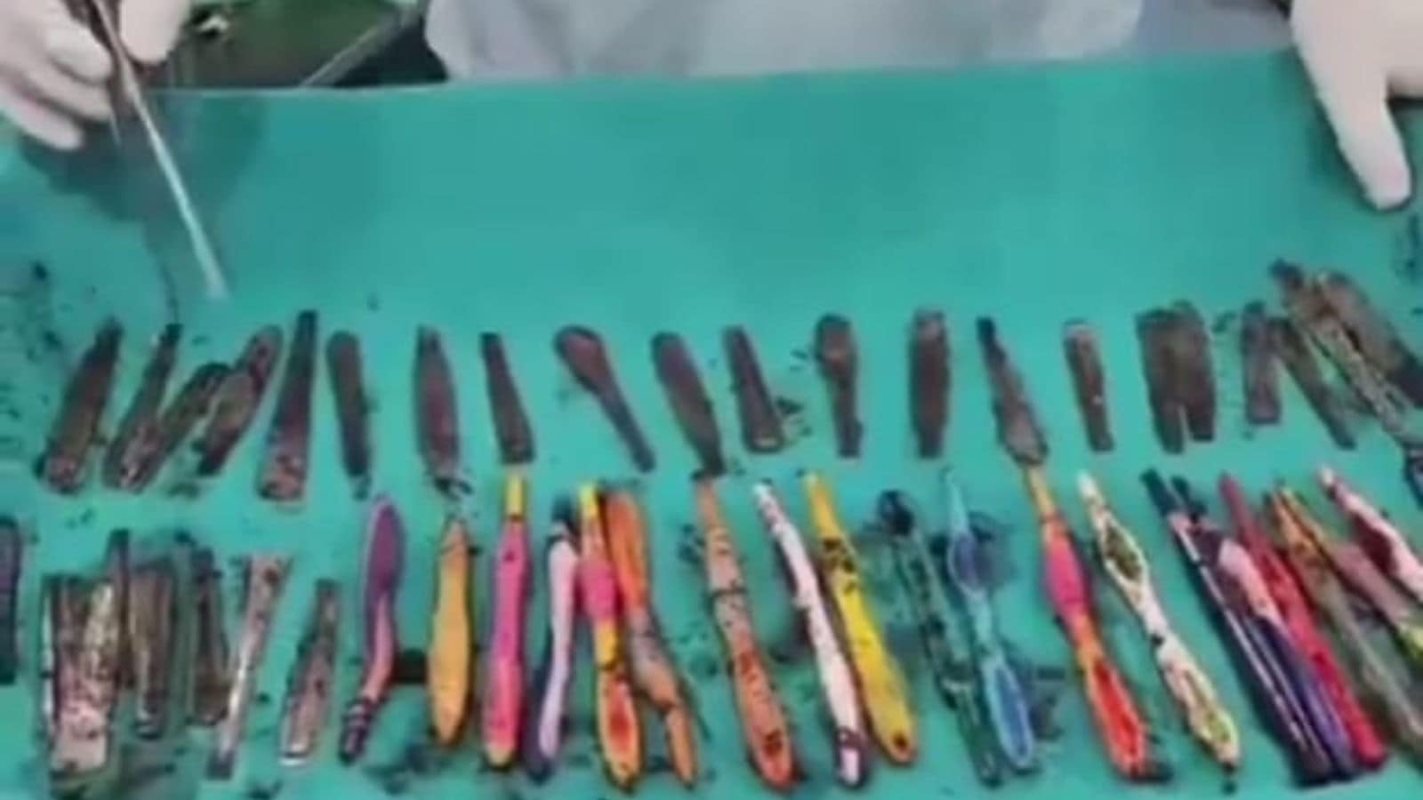 Steel spoons, pens and toothbrushes — Hapur man swallows 50 items, lands in hospital | Delhi ...