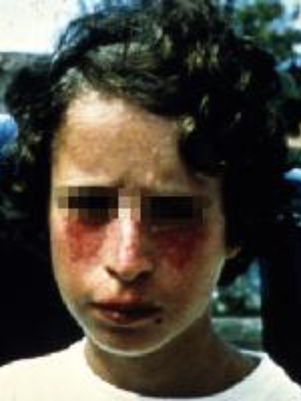 What is Bloom Syndrome? Know its symptoms