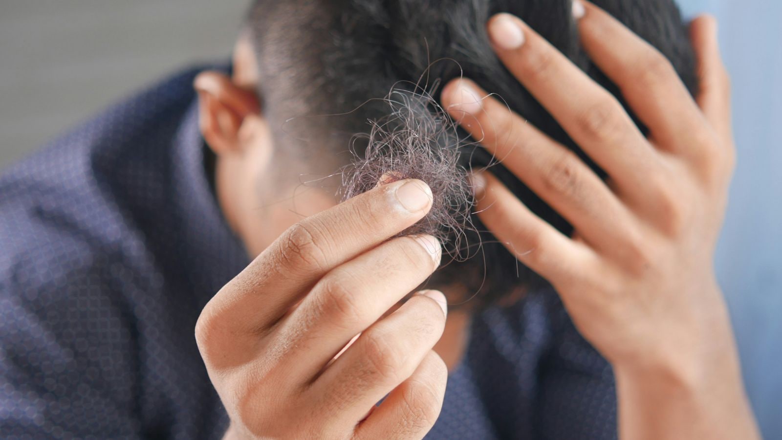 Young Edge: Excessive hair loss, the head-scratching issue of Gen Z ...