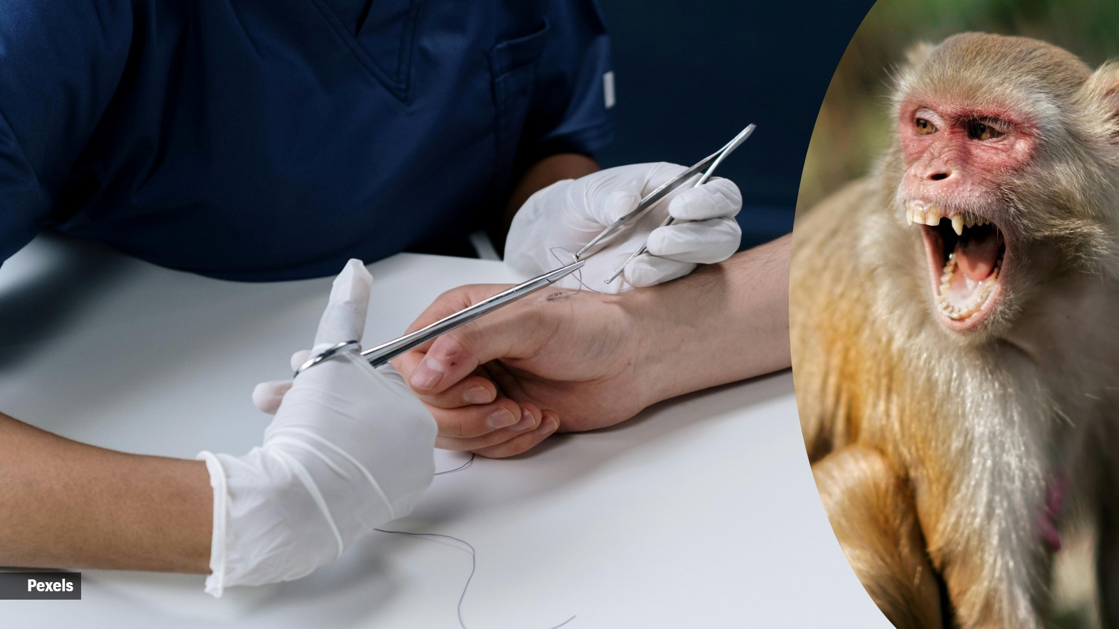 Warning signs to look out for after a monkey bite