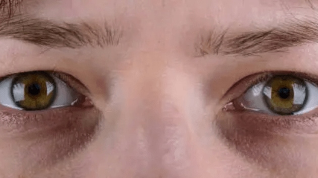 Reasons your eyes are watery | Lifestyle Gallery News - The Indian Express