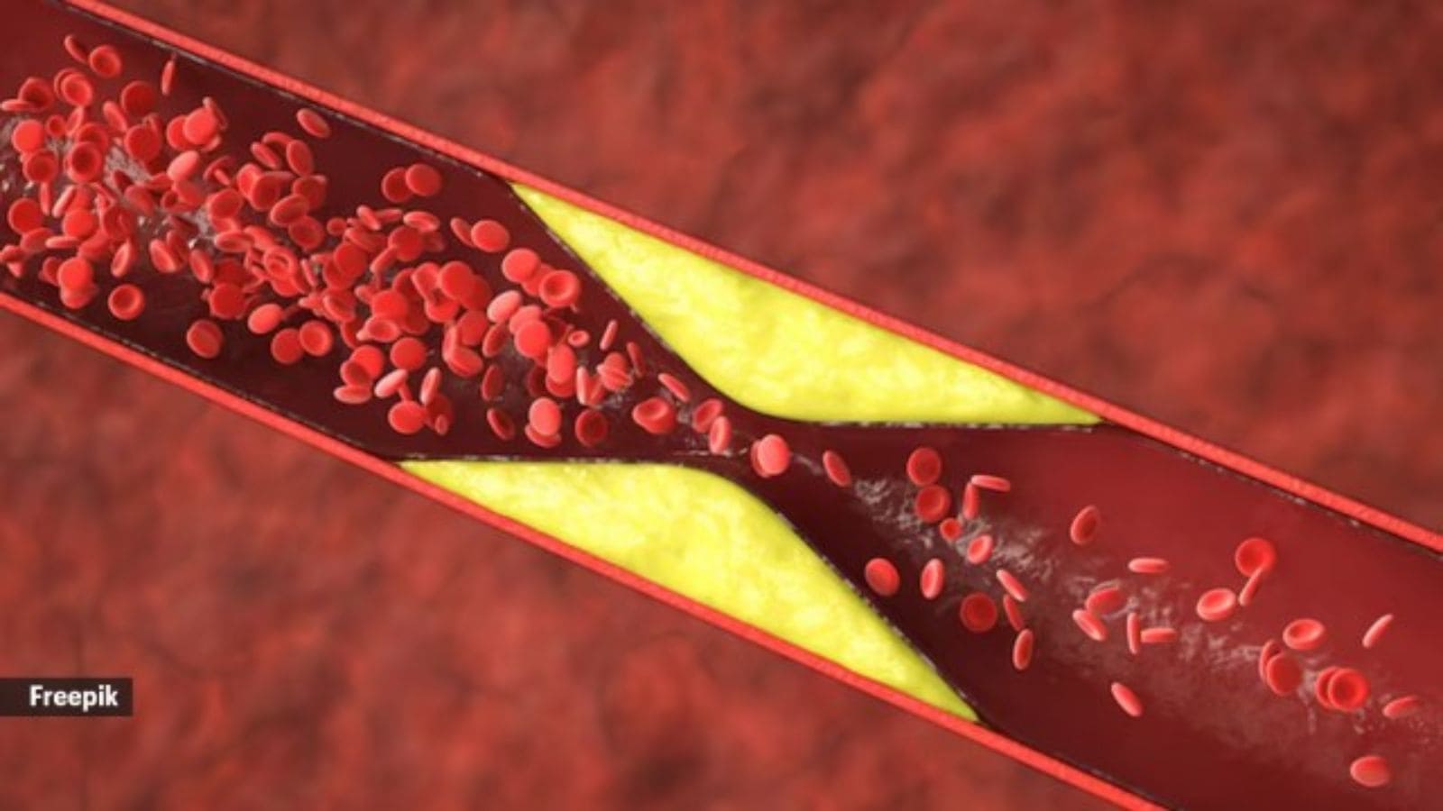 New pill cuts LDL cholesterol by 60 per cent, show trials ...
