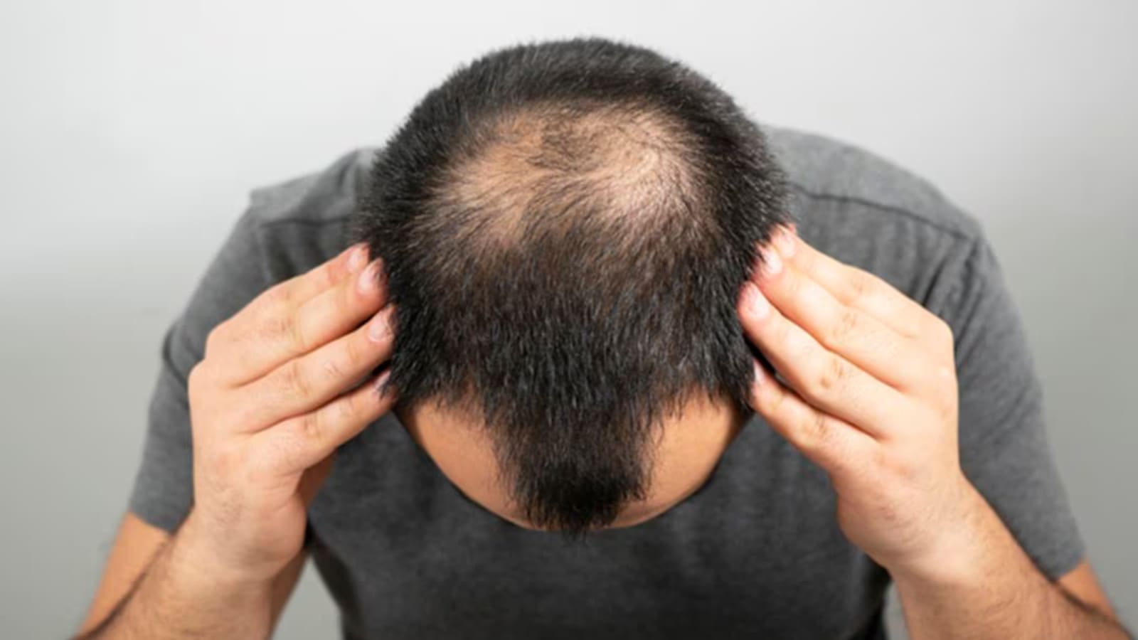 After 3 failed hair transplants, hair regrows in 44-year-old: How to ...