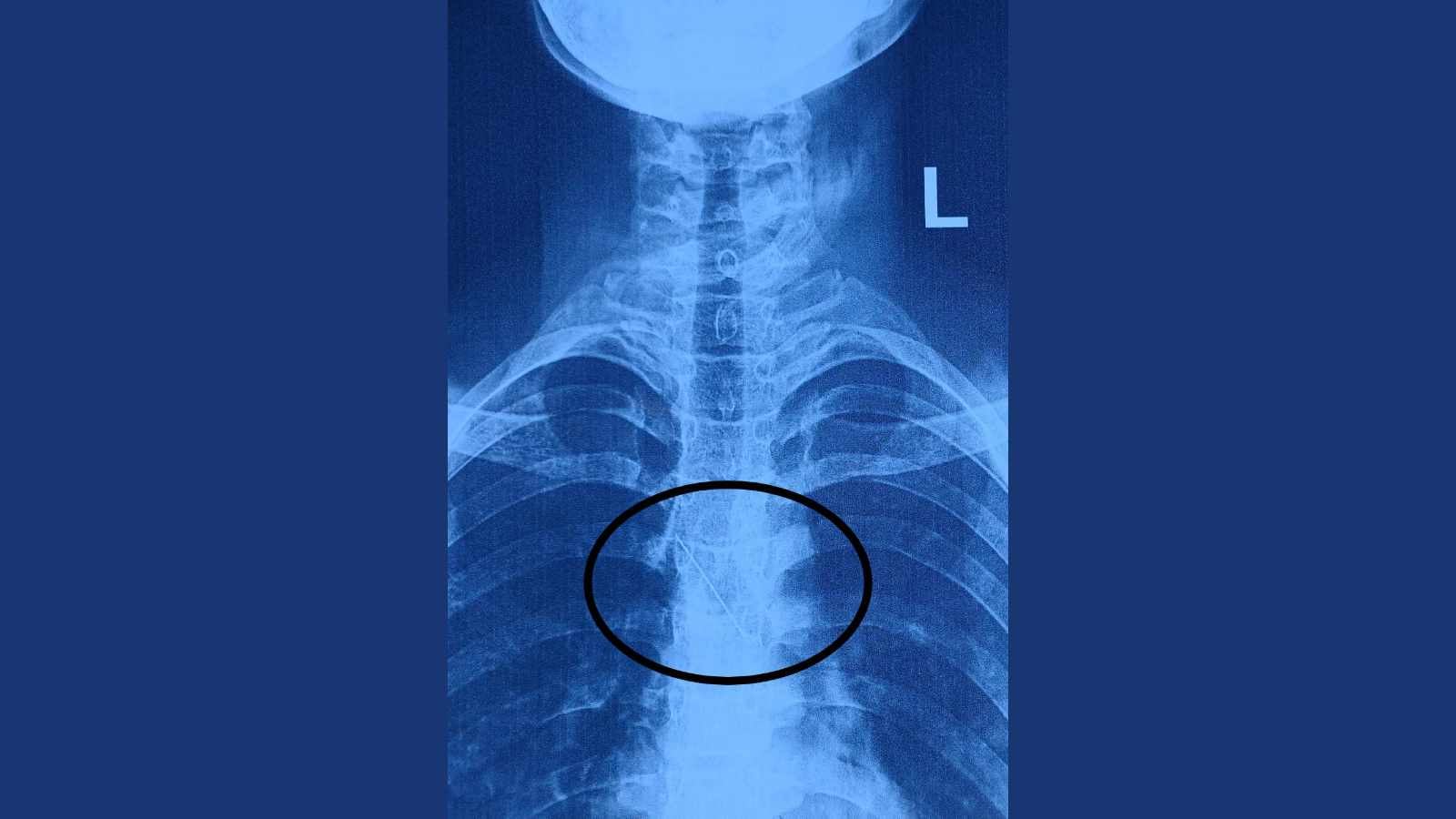 Why you should never hold pins in your mouth: Vadodara teen girl’s ...